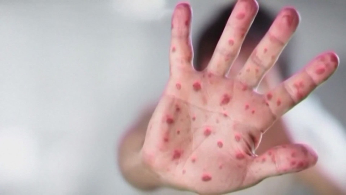 3 measles cases confirmed in Ohio’s first outbreak of 2026 | wtol.com