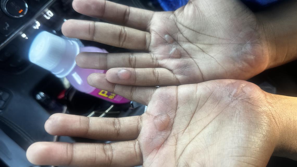 Indiana students get second-degree burns from punishment | wtol.com