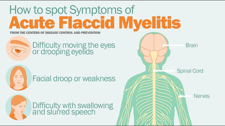 2nd child case of acute flaccid myelitis confirmed in Michigan | wtol.com