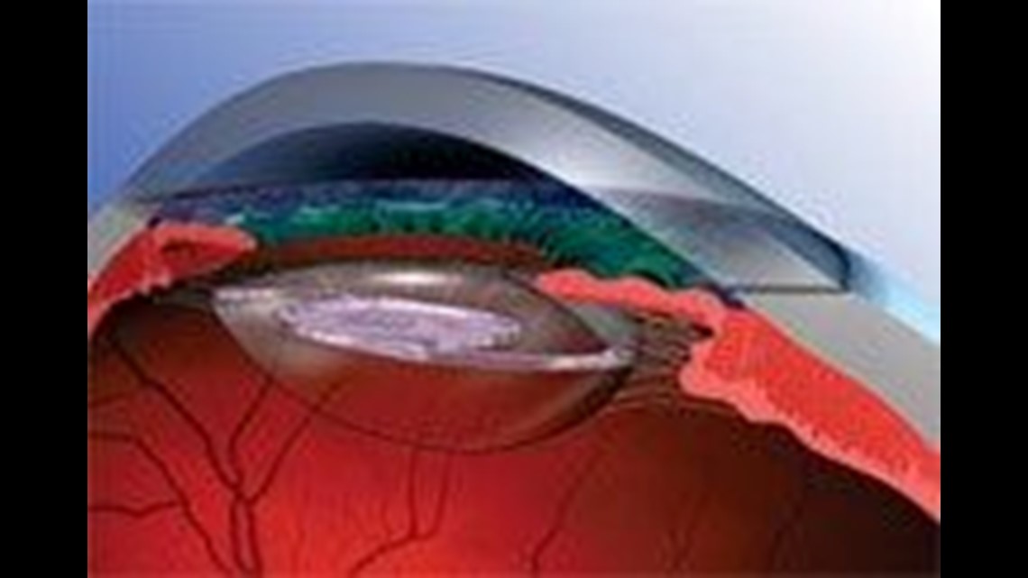 Multi-Focal IOL's | wtol.com