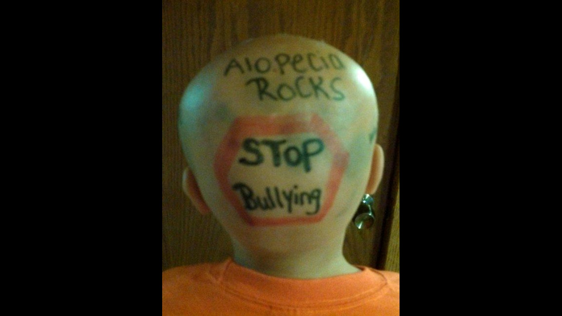 8-year-old decorates bald head to protest bullying | wtol.com