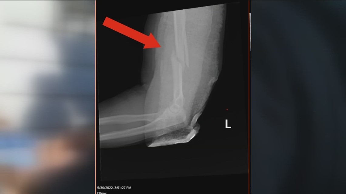 Toledo Woman Sues Tpd Alleges Officers Broke Her Arm During 2022